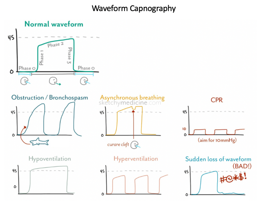 Should Waveform Capnography be in the EMT Scope of Practice? (Part 2) - NAEMSP