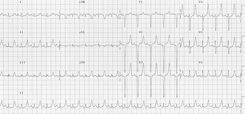 Field Management and Recognition of Hyperkalemia - NAEMSP