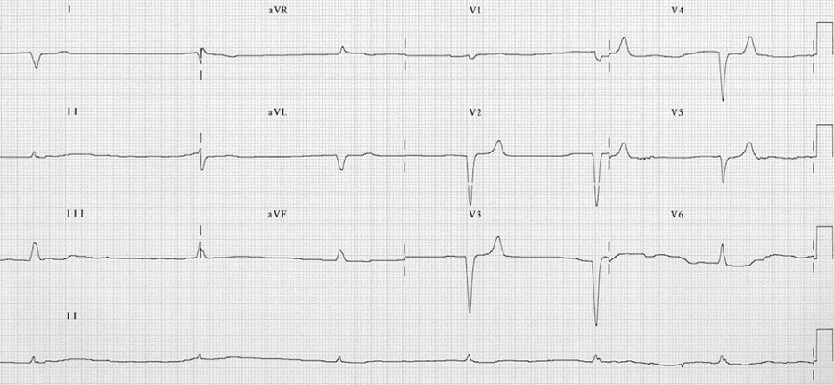 Field Management and Recognition of Hyperkalemia - NAEMSP
