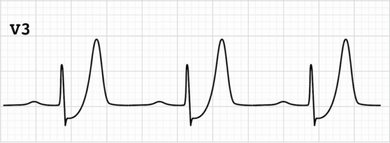 OMI, NOMI, and EMS: The Case for EMS Recognition of Occlusive MI - NAEMSP