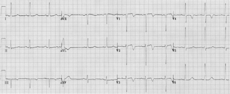 OMI, NOMI, and EMS: The Case for EMS Recognition of Occlusive MI - NAEMSP