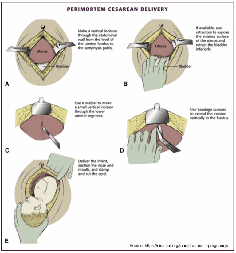Maternal Cardiac Arrest: Physiologic Considerations, Resuscitation ...